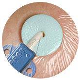 BIOPATCH Antimicrobial Dressing